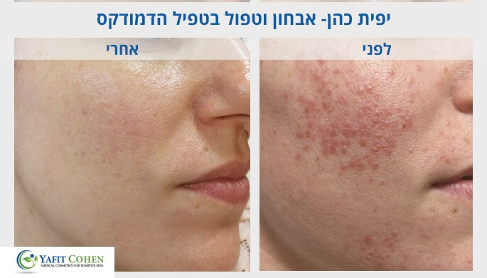 רוזציאה ודמודקס - Yafit Cohen - יפית כהן